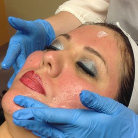 Microneedling - Luminous Dermatology