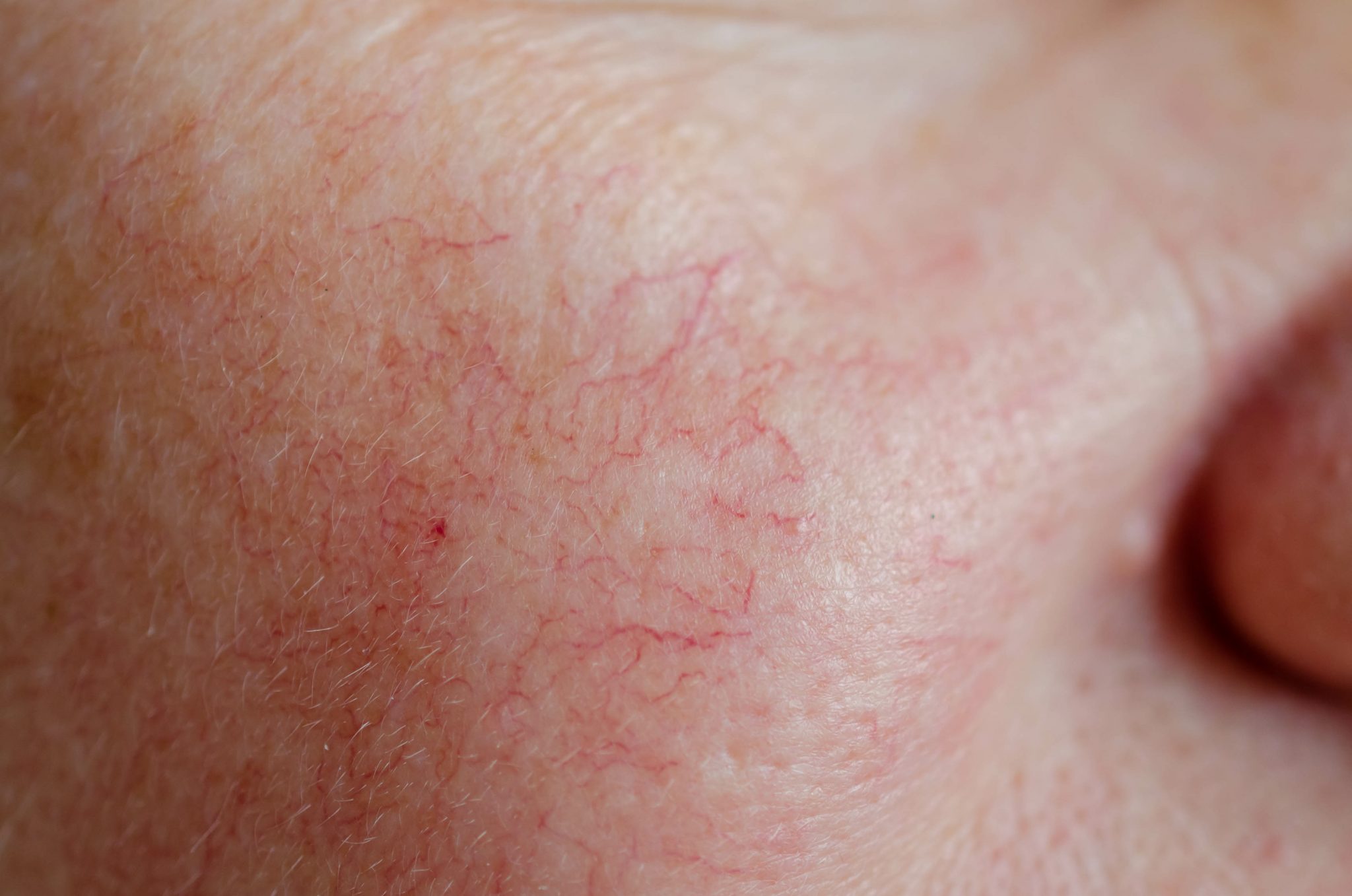 Broken Blood Vessels (Telangiectasias) - Luminous Dermatology