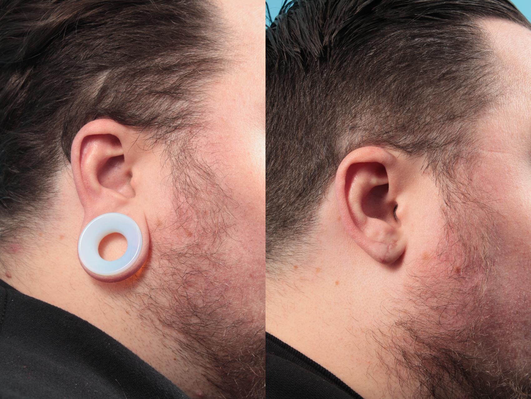 Ear Lobe Repair - Luminous Dermatology