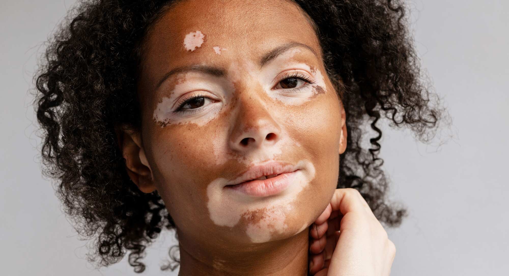 Vitiligo - Luminous Dermatology